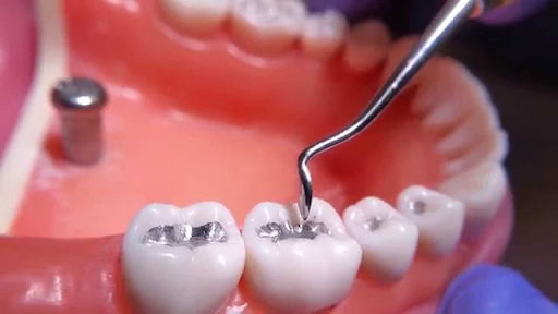 FDA Finally Acknowledges the Risk of Amalgam in High Risk Population ...